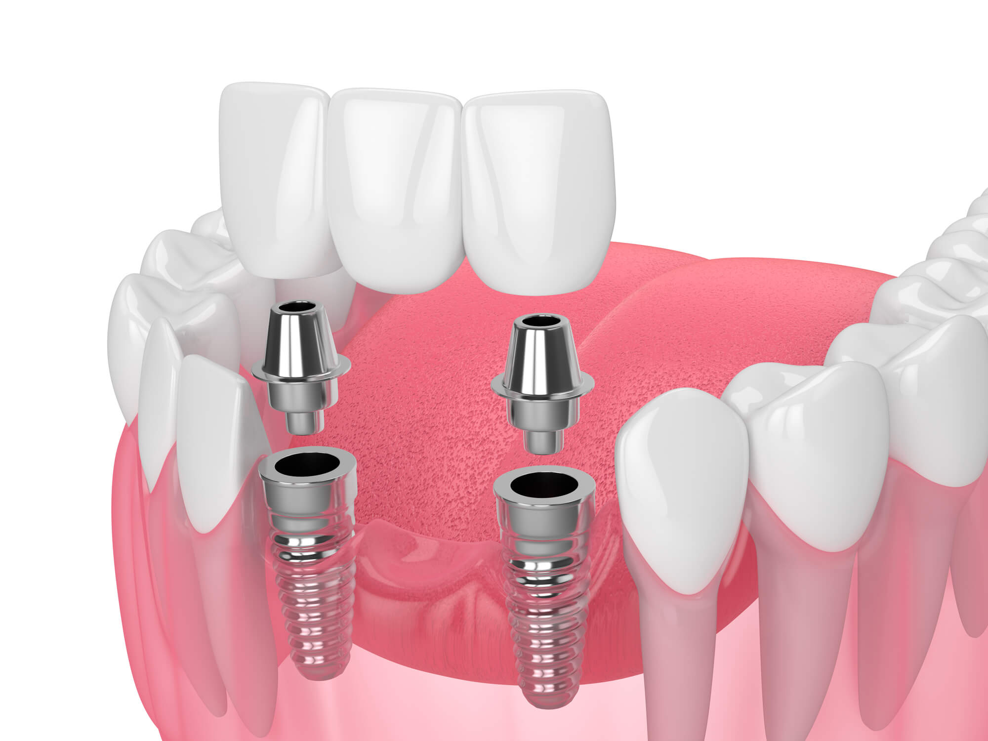 The Dental Implant Process Explained