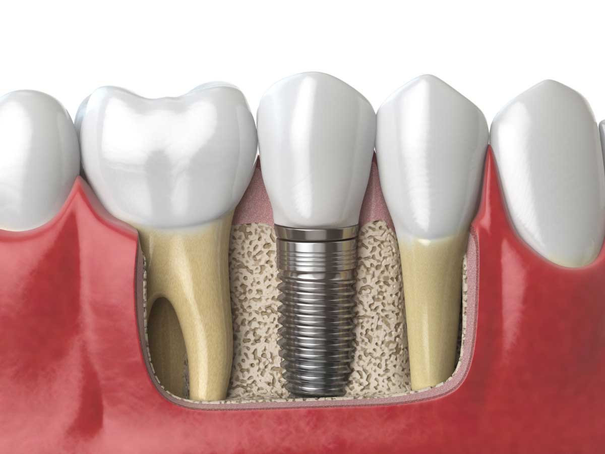 Cost Of Dental Implants | Tryon Family Dentistry